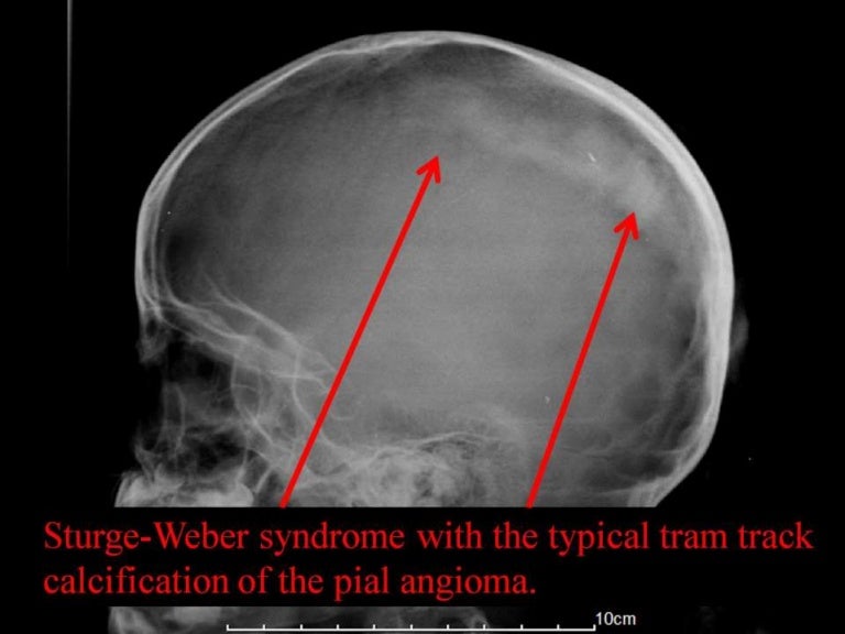 Case sturge weber syndrome Dr Ahmed Esawy