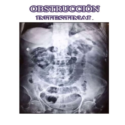 Caso clínico obstruccion intestinal.docx
