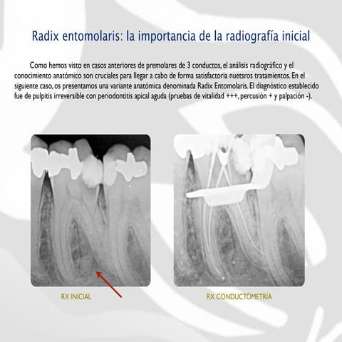 Radix entomolaris: la importancia de la radiografía inicial | KEY
