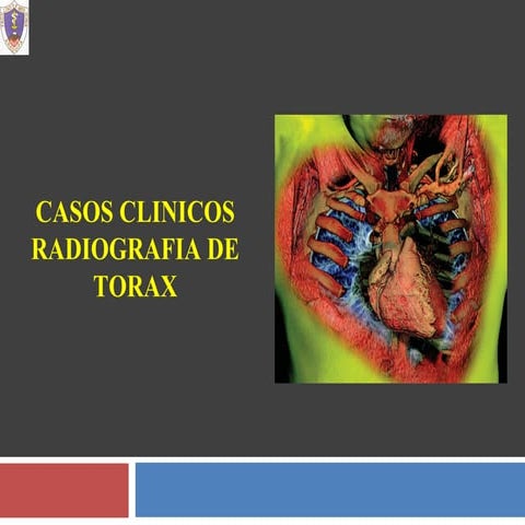 CASOS CLINICOS RADIOGRAFIAS DE TORAX by Rudy Paucara | PPT