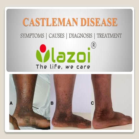 Castleman Disease : Symptoms, causes, diagnosis and treatment | PPTX