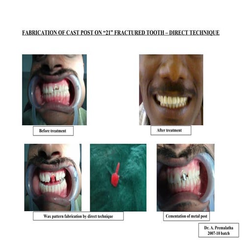 Cast post/cosmetic dentistry course by Indian dental academy | PPT