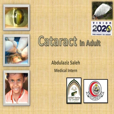 Cataract | PPTX