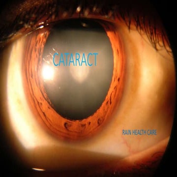 Cataract | PPTX
