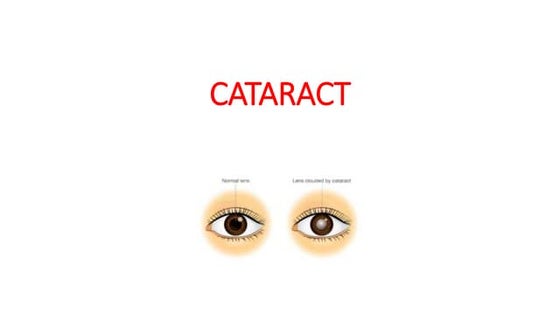 Cataract | PPT