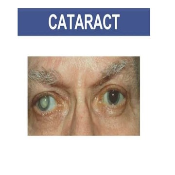 cataract | PPT