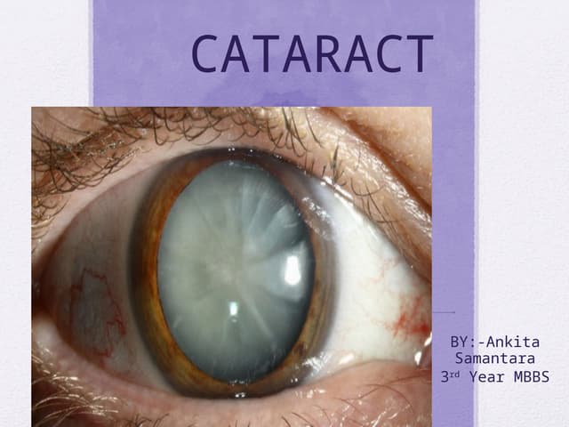 Stages and clinical features of cataract.pptx