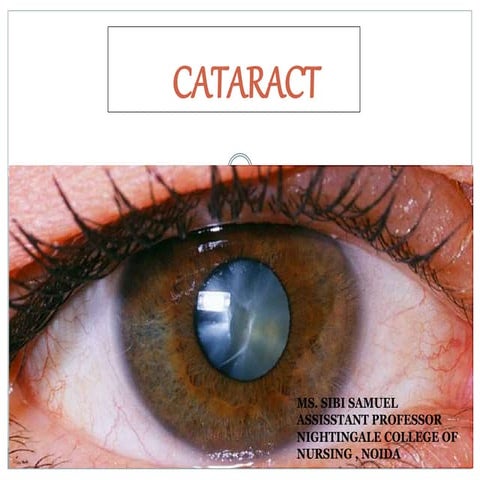 Cataract Definition The BEST Cataract Surgery Lenses Options Doctor