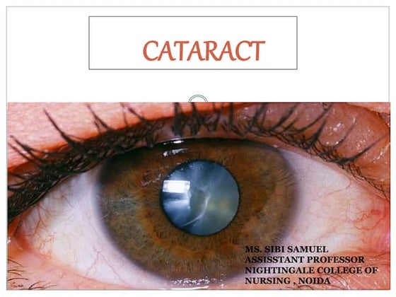 Cataract | PPT