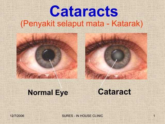 CATARACT CASE PRESENTATION(CASE STUDY) | DOCX