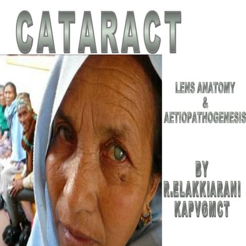 Cataract | PPT | Eye and Vision Conditions | Diseases and Conditions