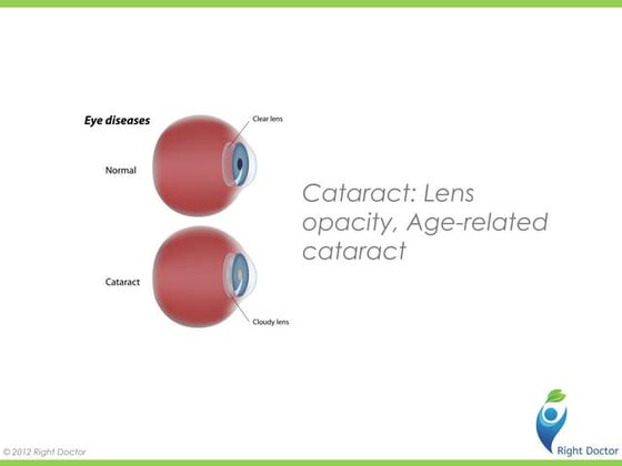 Cataracts | DOCX | Eye and Vision Conditions | Diseases and Conditions
