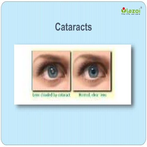 Cataracts | PPTX | Eye and Vision Conditions | Diseases and Conditions