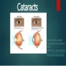 Cataracts | PPTX