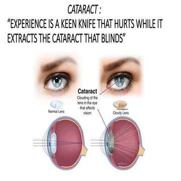 CATARACTS.pptx