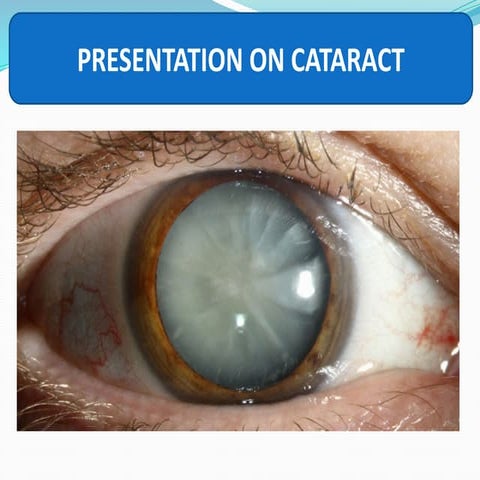 CATARACT SEMINAR PRESENTATION WITH PATHOPHYSIOLOGY | PDF