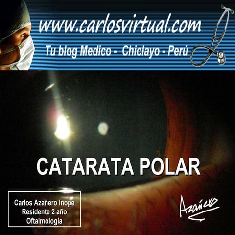 Catarata polar | PPT