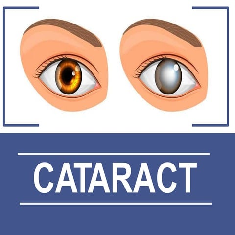 Catract ppt | PDF