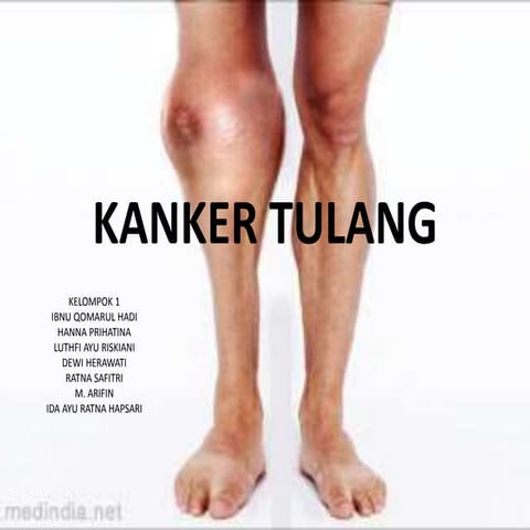 kanker tulang | PPTX