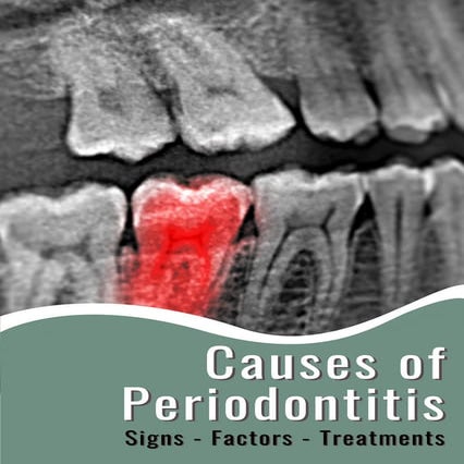 Causes of periodontitis | PDF