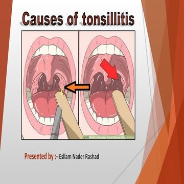 Causes of tonsillitis.pptx