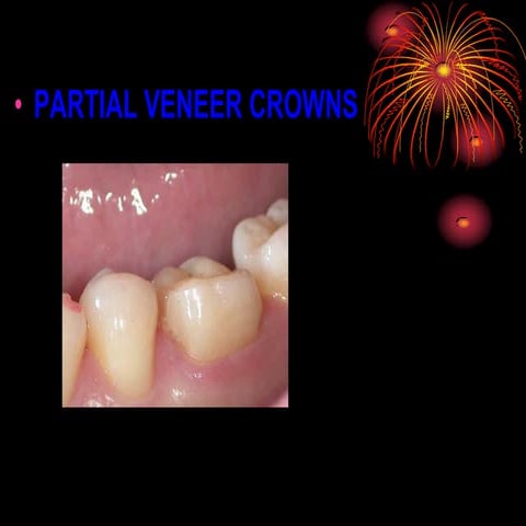 partial coverage restorations | PDF