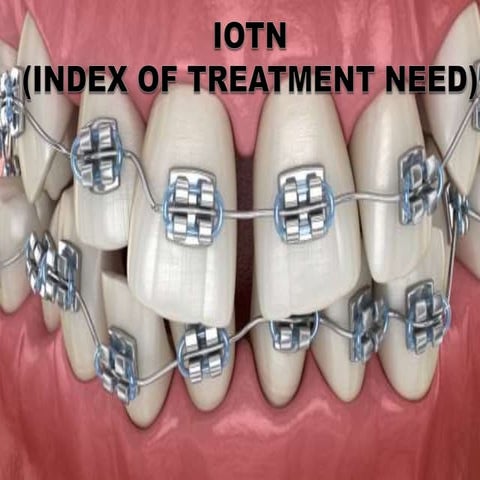 Index of Orthodontic Treatment Need (IOTN) | PDF