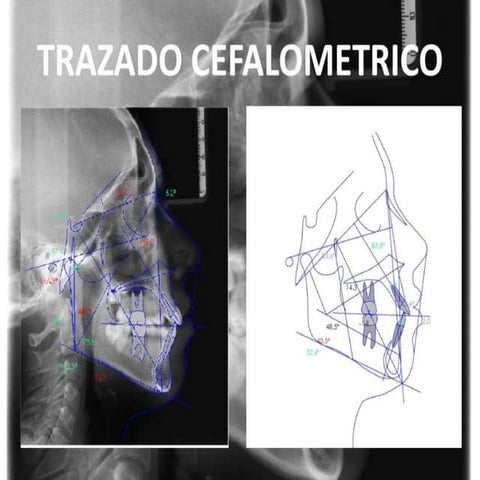 Cefalometria dr. huete 003 | PPT