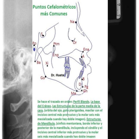 Cefalometria dr. huete 009 | PPTX
