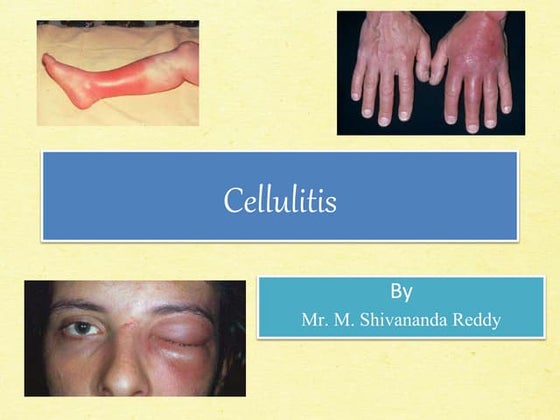 Cellulitis | PPTX | Skin and Dermatology | Diseases and Conditions