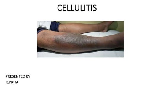 Cellulitis | PPT