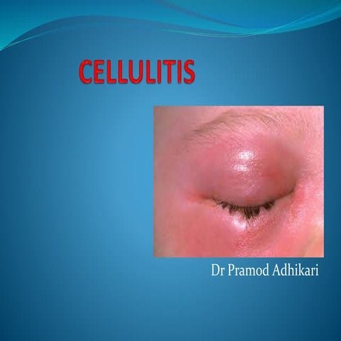 Cellulitis Superficial Bacterial Infection Pptx