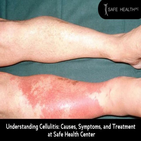 cellulitis causes,symptoms and treatment at safe health center in Mt ...
