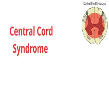 Central Cord Syndromes and it’s symptoms | PPTX