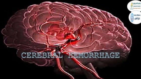INTRA CRANIAL HEMORRHAGE- AGING BLOOD ON MRI | PPTX
