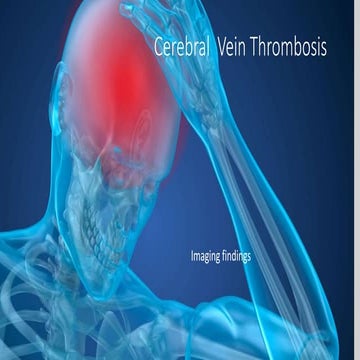 Cerebral venous thrombosis may cause stroke in young patients | PPTX