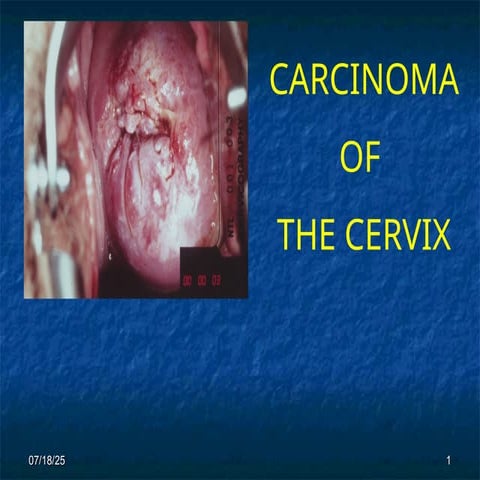 Cervical carcinoma Cervical cancer remains a common malignancy ...