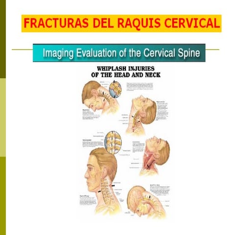 Cervical fracture | PPT