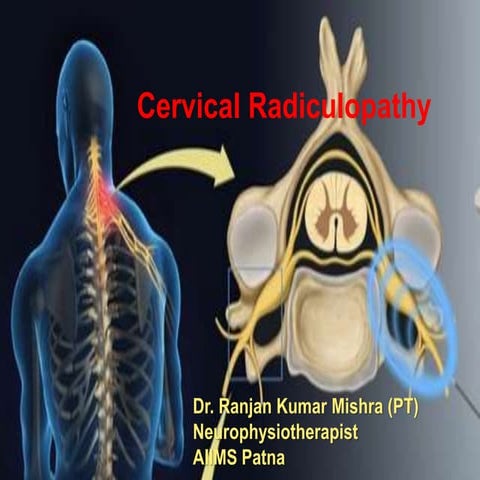 Cervical radiculopathy | PPTX