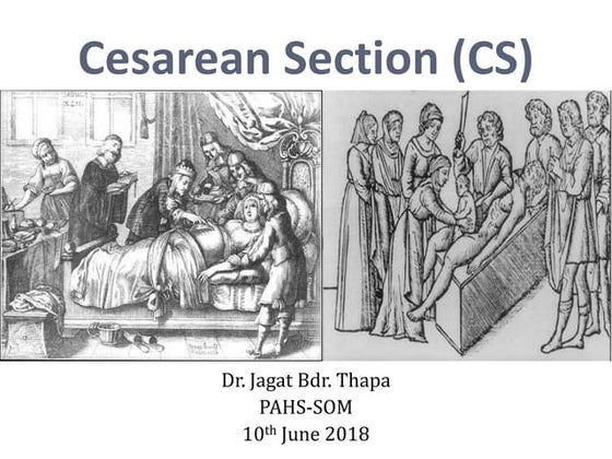 C section | PPT