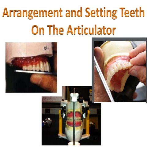 arrangement and setting teeth on the articulator | PPT