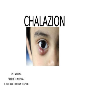 CHALAZION.pptx