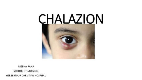 Conjunctivitis | PPT