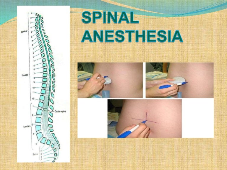 Chapter 8 spinal Anaesthesia chapter-8-spinal-anaesthesia