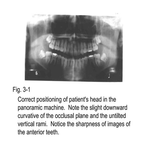 Positioning Errors in Panoramic Radiography | PDF