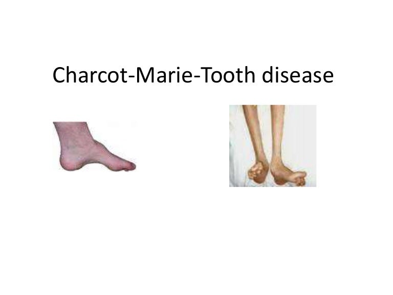 Charcot marie-tooth disease