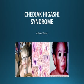 CHEDIAK HIGASHI SYNDROME, causes, types, clinical features | PPTX