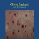 (Dr HA) Cherry Angioma - U Mạch Anh Đào / Bs Võ Hoàng Anh | PPTX