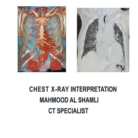 CHEST interpretiation with example (2).pptx