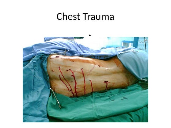 CHEST INJURIES.ppt